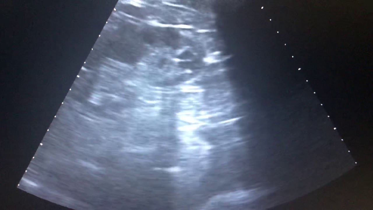 Renal lithiasis Ultrasound Litiasis renal Ecografia - YouTube