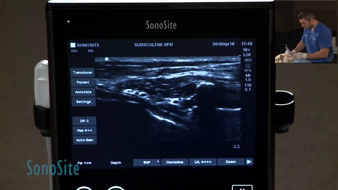 Ultrasound Guided Brachial Plexus Nerve Block in a Dog: Part 3 of 3 ...
