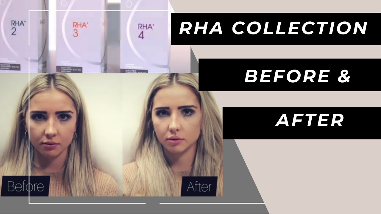 RHA Procedure Before & After - YouTube