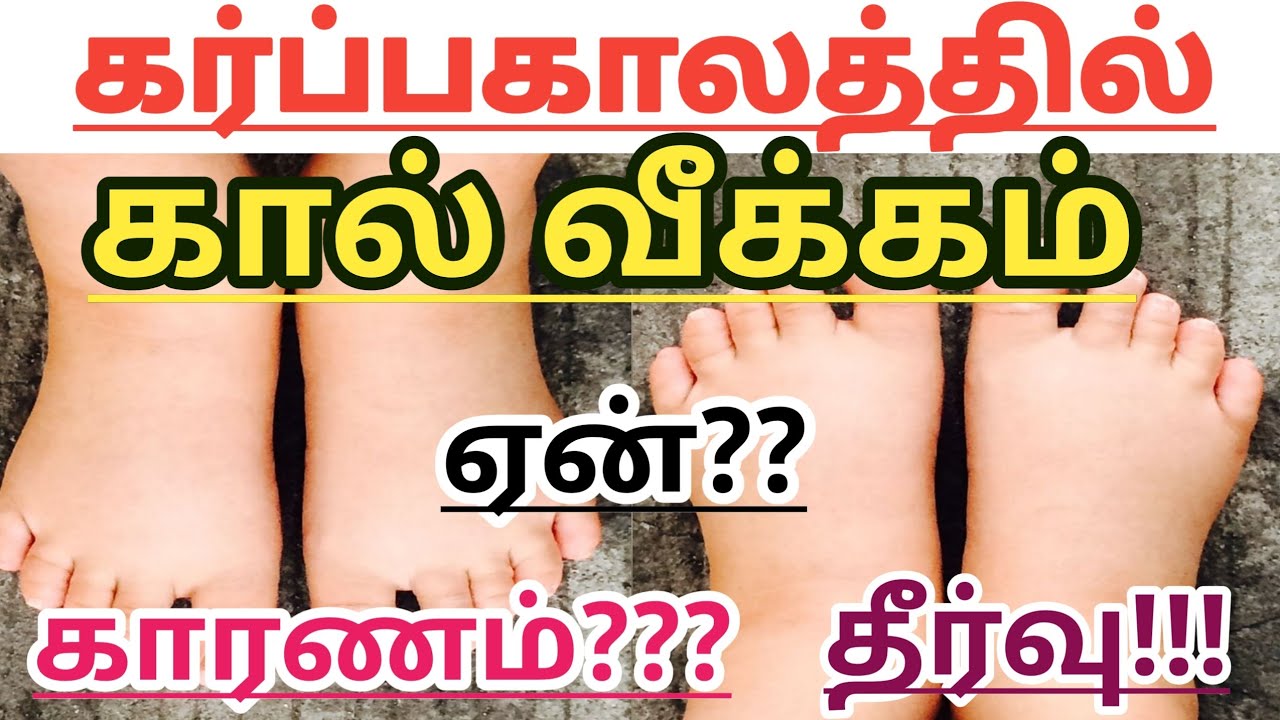Leg Swelling During pregnancy || karpa kala kaal vekkam|| Swelling Feet ...