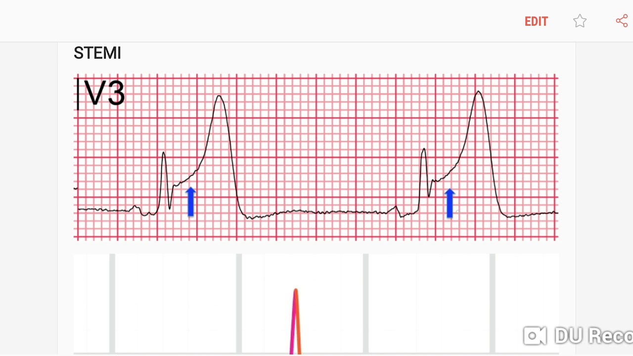 STEMI on ECG - YouTube