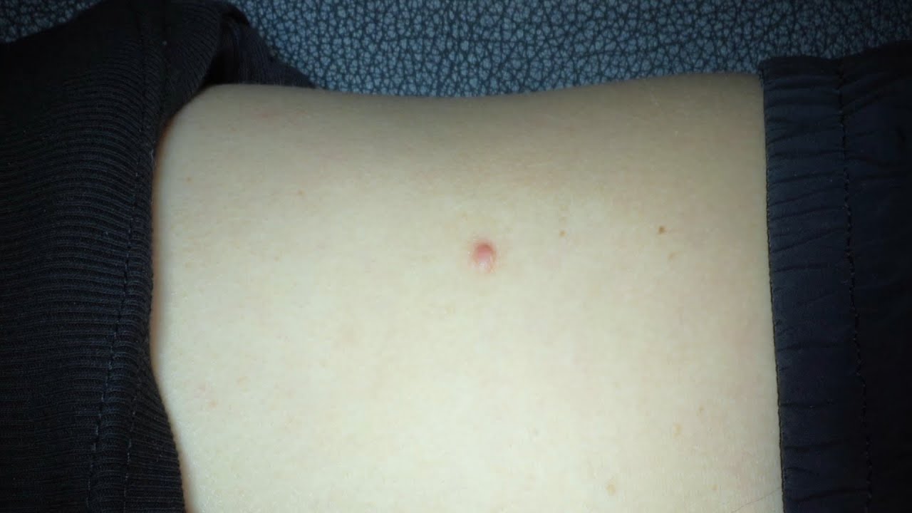 Neurofibroma on Back Removal Surgery (HD) 젊은 여성의 등에 생긴 신경섬유종 제거 수술 / 수원 ...