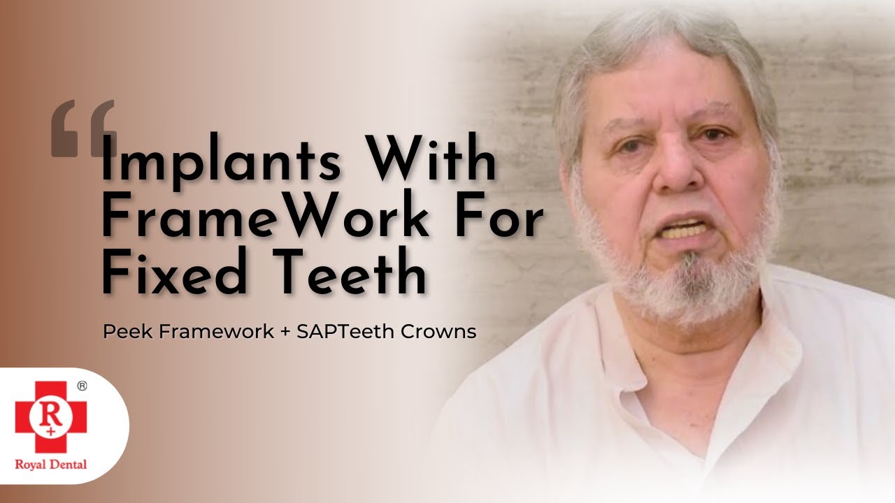 Implants with PEEK Framework for Fixed Teeth | SAPTeeth Crown for Full ...