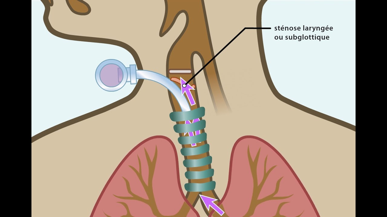 La canule de trachéotomie: Valve de phonation et bouchons [en français ...