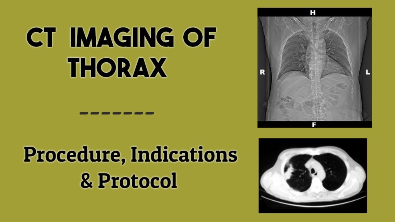 CT Imaging of Thorax | CT Thorax Procedure | CT Thorax indications | CT ...