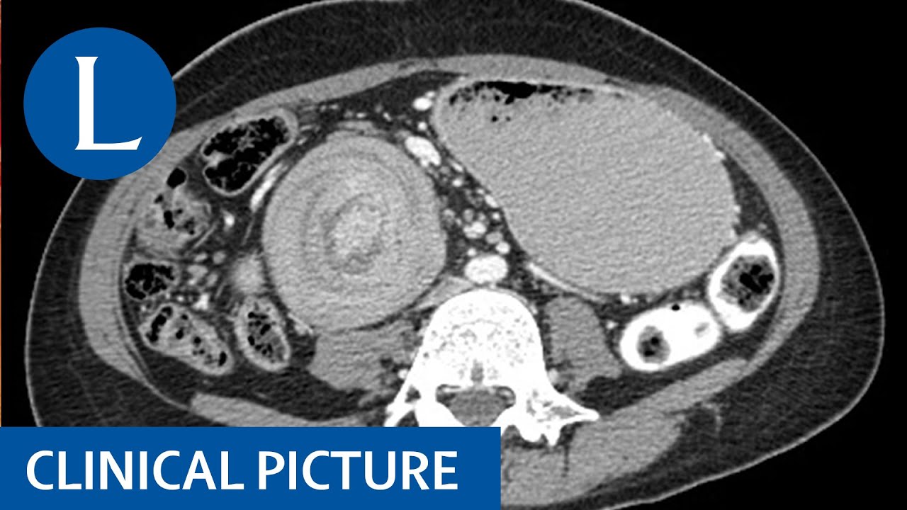 Abdominal pain and recurrent vomiting: target sign on CT scan - YouTube