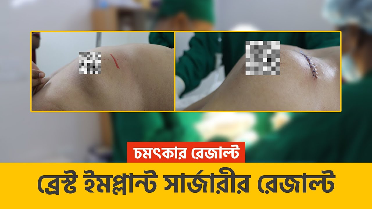 Breast Implant Surgery in Bangladesh by Dr Sharif। স্ত ন বড় করার সার্জারী। Dr Sharif - YouTube
