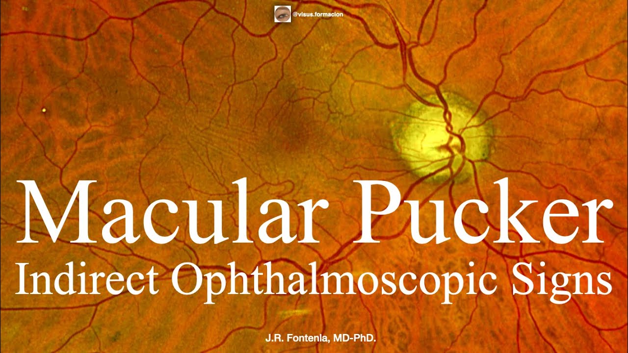 Macular Pucker. Indirect Ophthalmoscopic Signs. - YouTube