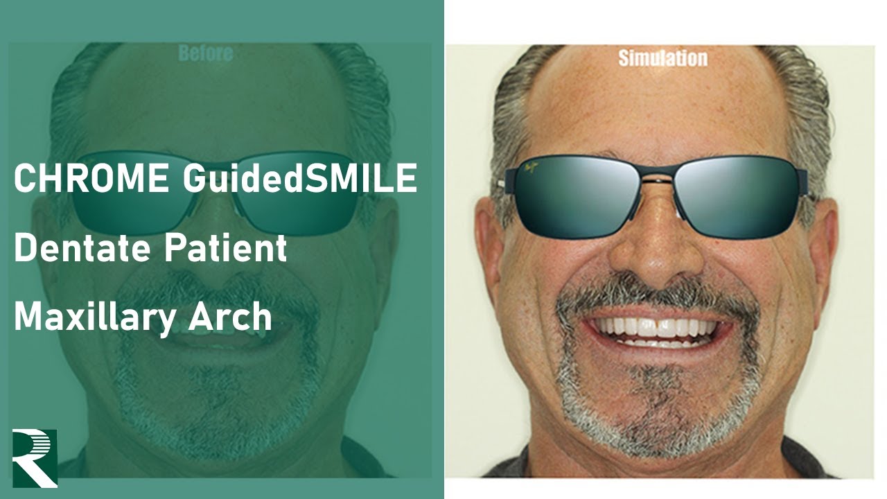 Full Arch Guided Surgery with CHROME GuidedSMILE: Dentate patient ...