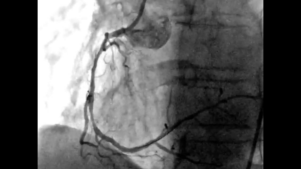 Myocardial infarction stent - YouTube