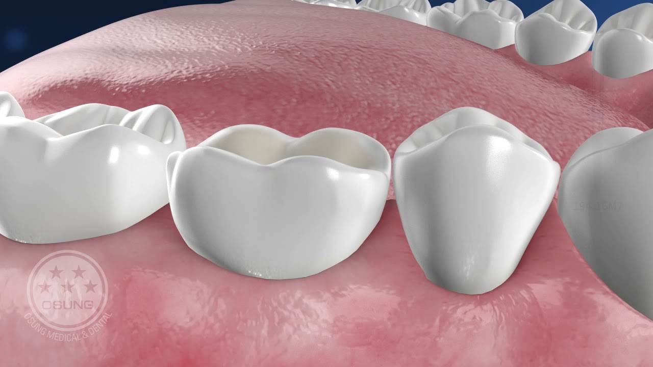Gold crown restoration posterior teeth - YouTube