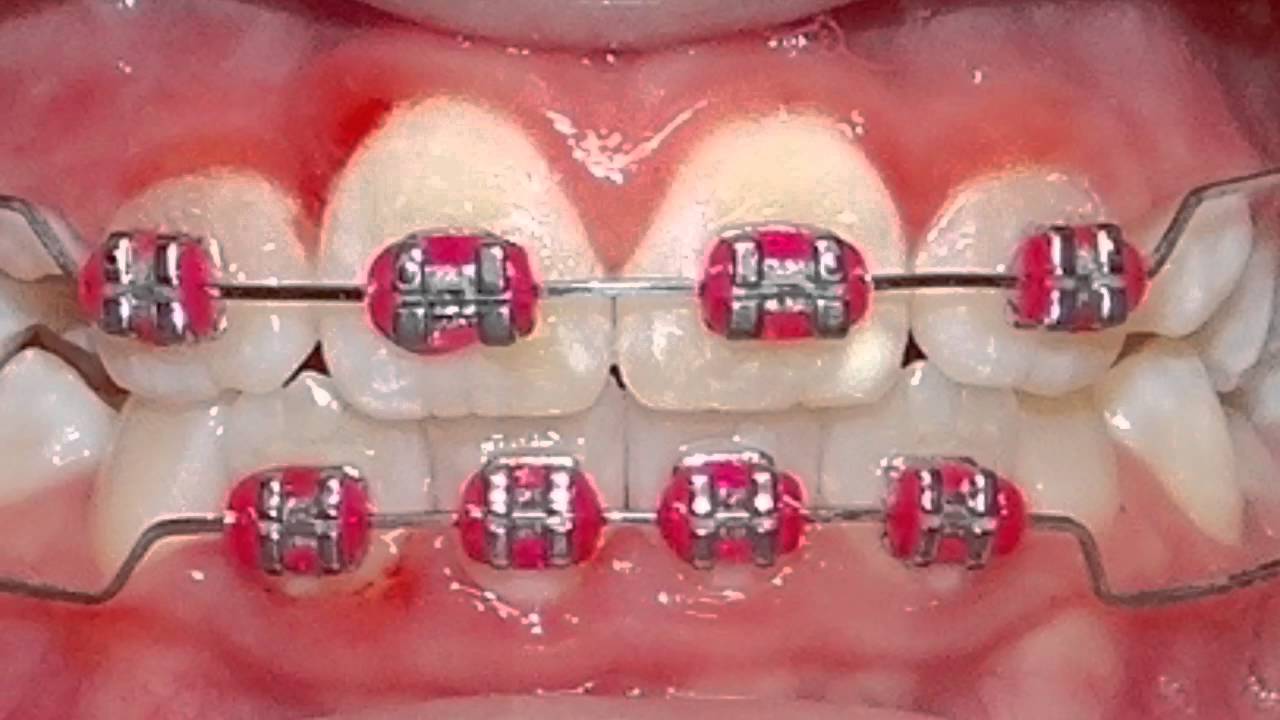 Ortodontia Bioprogressiva de Ricketts - YouTube