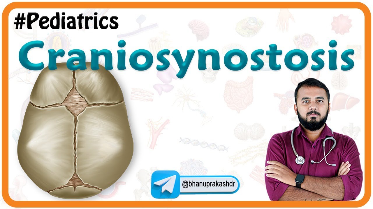 Craniosynostosis : Types, Causes, Diagnosis and Treatment : Pediatrics ...