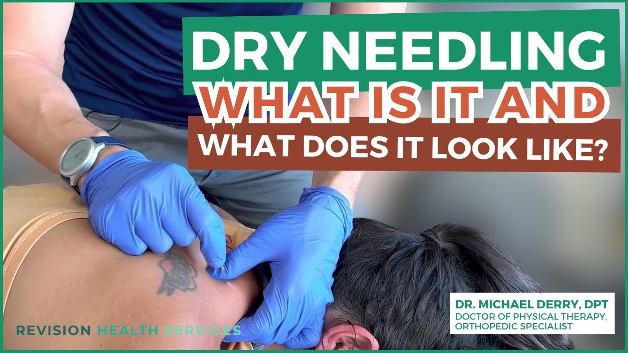 Dry needling in Jacksonville, FL - For neck pain, arthritis, hip pain ...