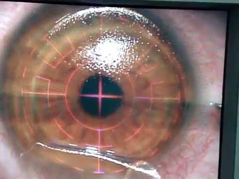 Cirugía láser en ojos (LASIK) - YouTube