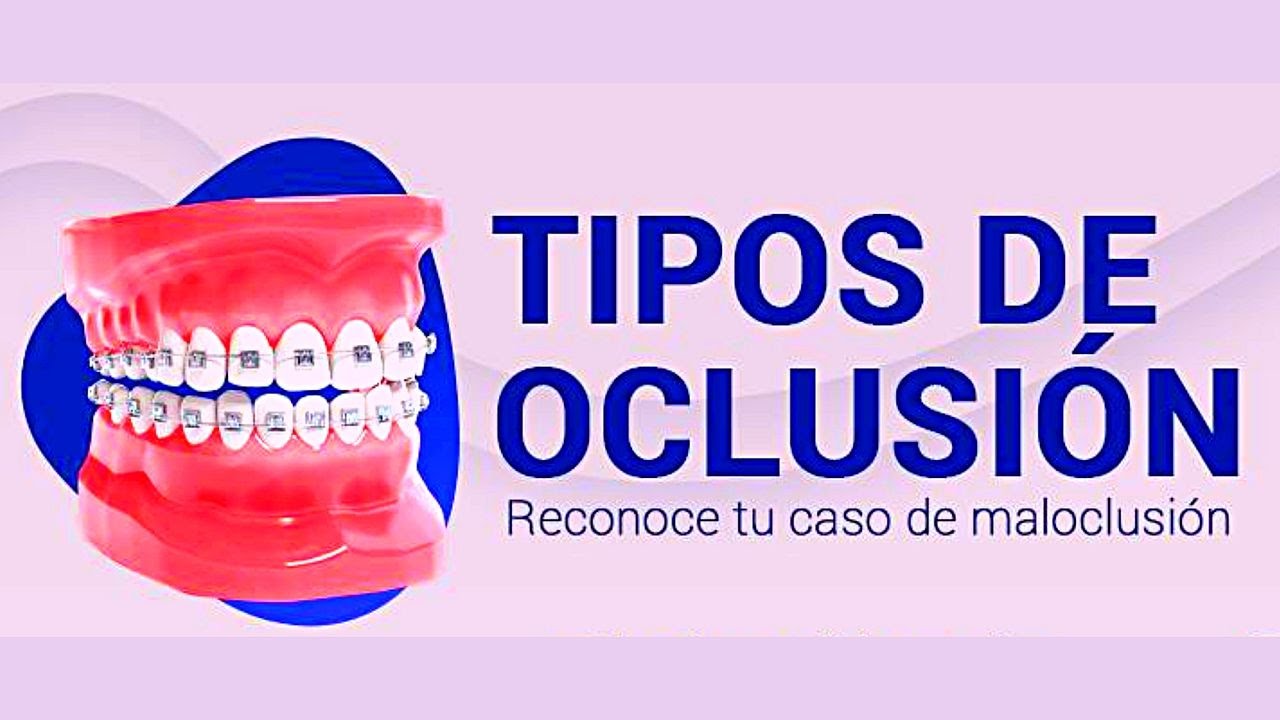 TIPOS DE OCLUSIÓN - Reconoce tu caso de Maloclusión - YouTube