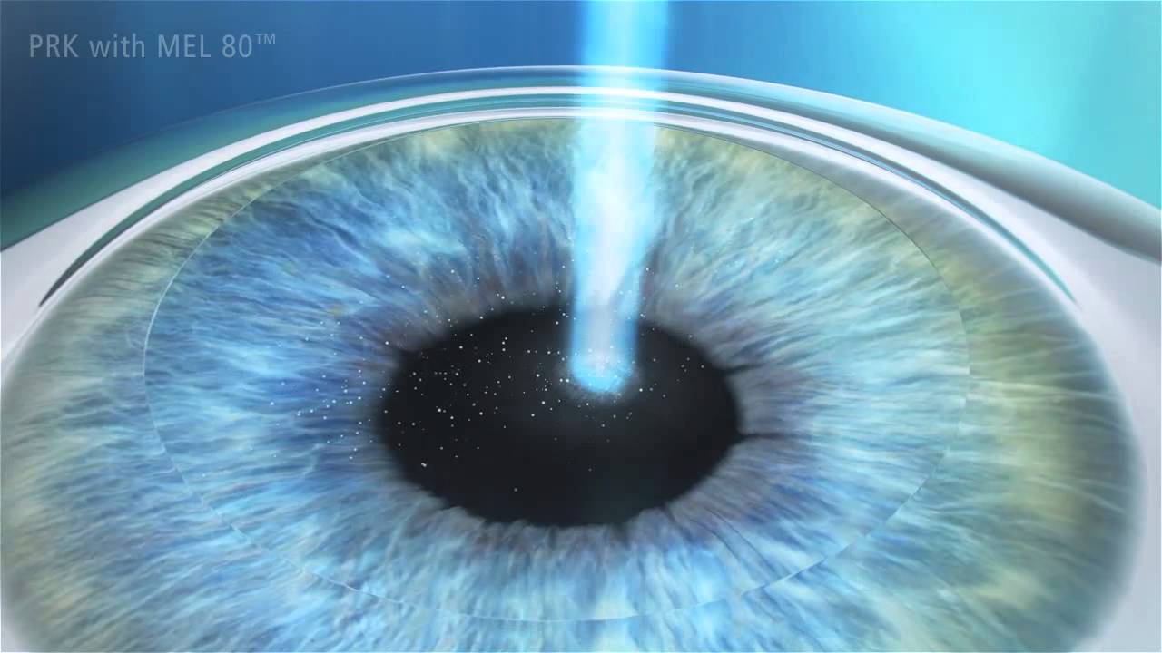 Laser Excimer - PRK - YouTube