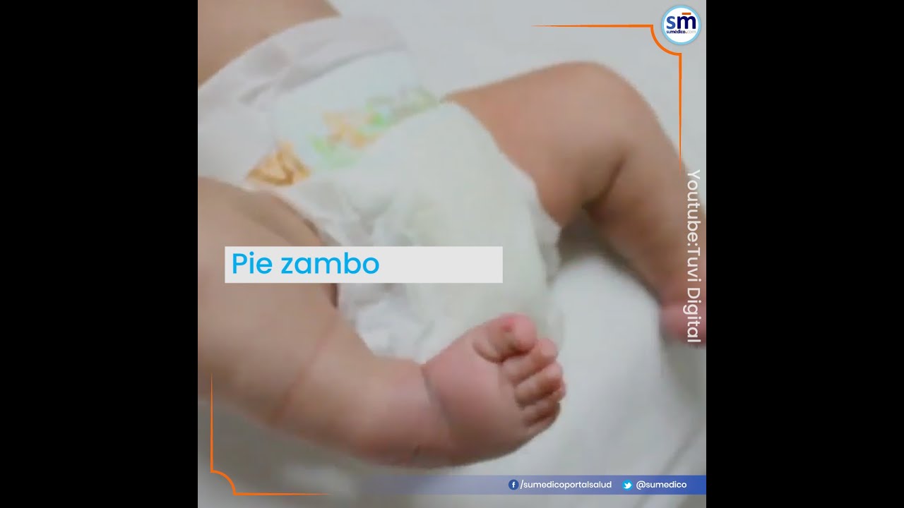 ¿Qué es el pie zambo? Te lo decimos: - YouTube