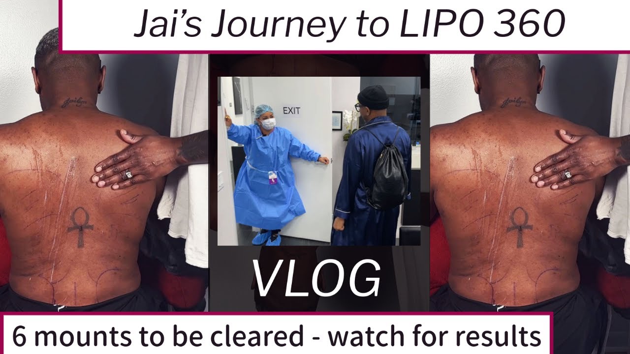 LIPO 360 VLOG - 6 MONTHS 2 B CLEARED - 2 DAY RESULTS - Jai & Joe - YouTube