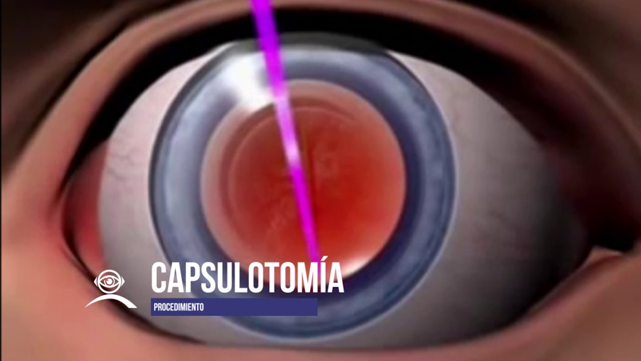 Capsulotomía Youtube