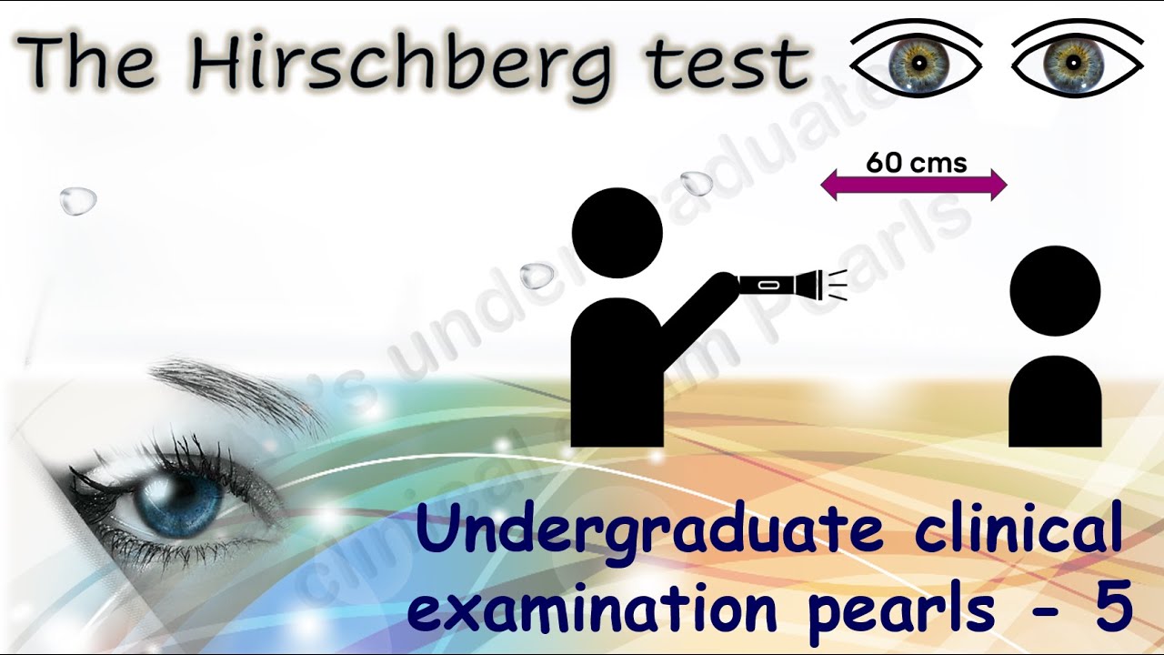 The Hirschberg Test | Undergraduate clinical examination pearls - 5 ...