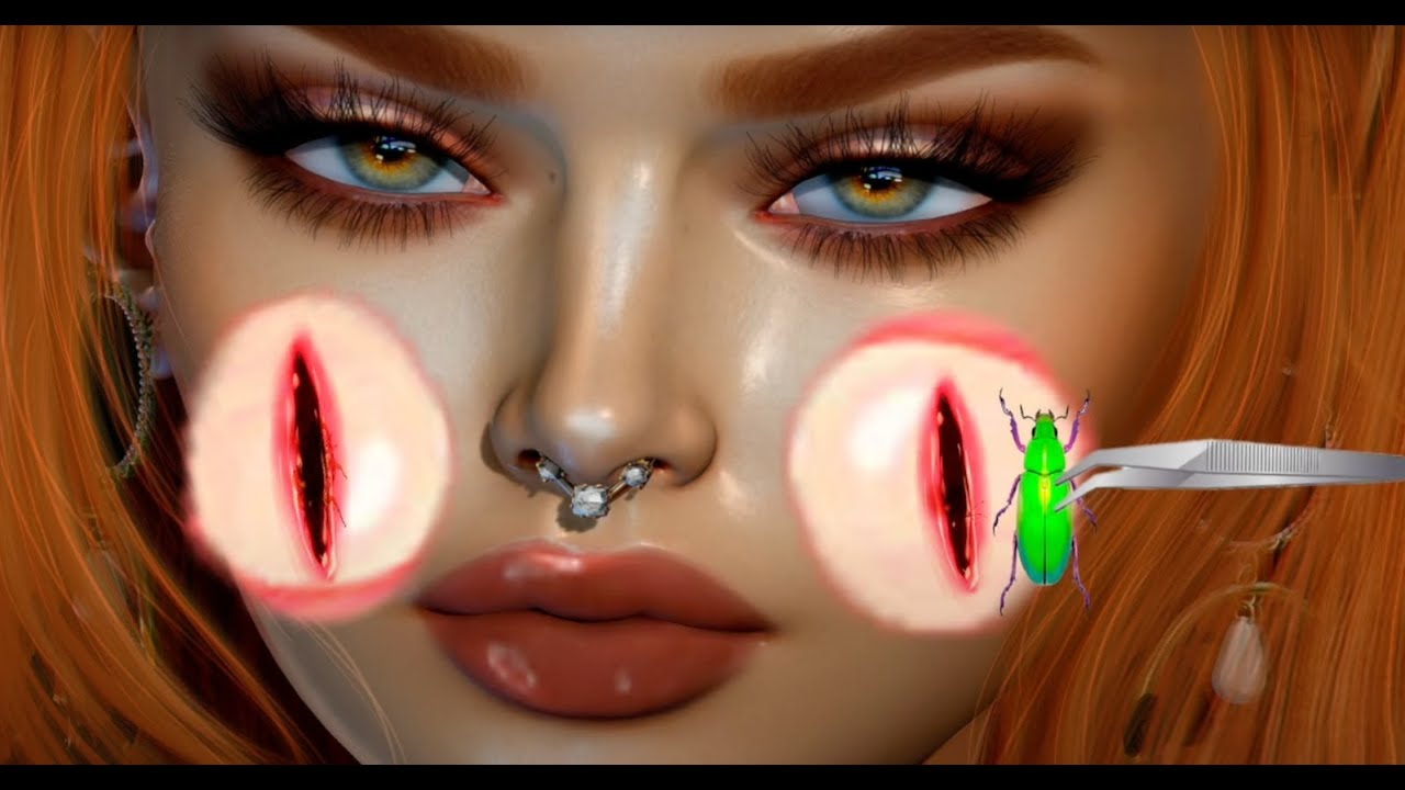 ASMR Remove Big Acne & Infected Face | Deep Cleaning Animation - YouTube