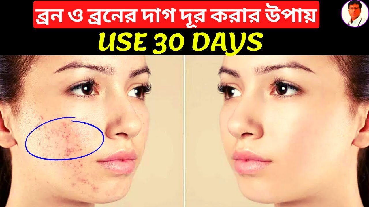 Acne and Pimple Best Homeopathic Treatment | best homeopathic medicine ...