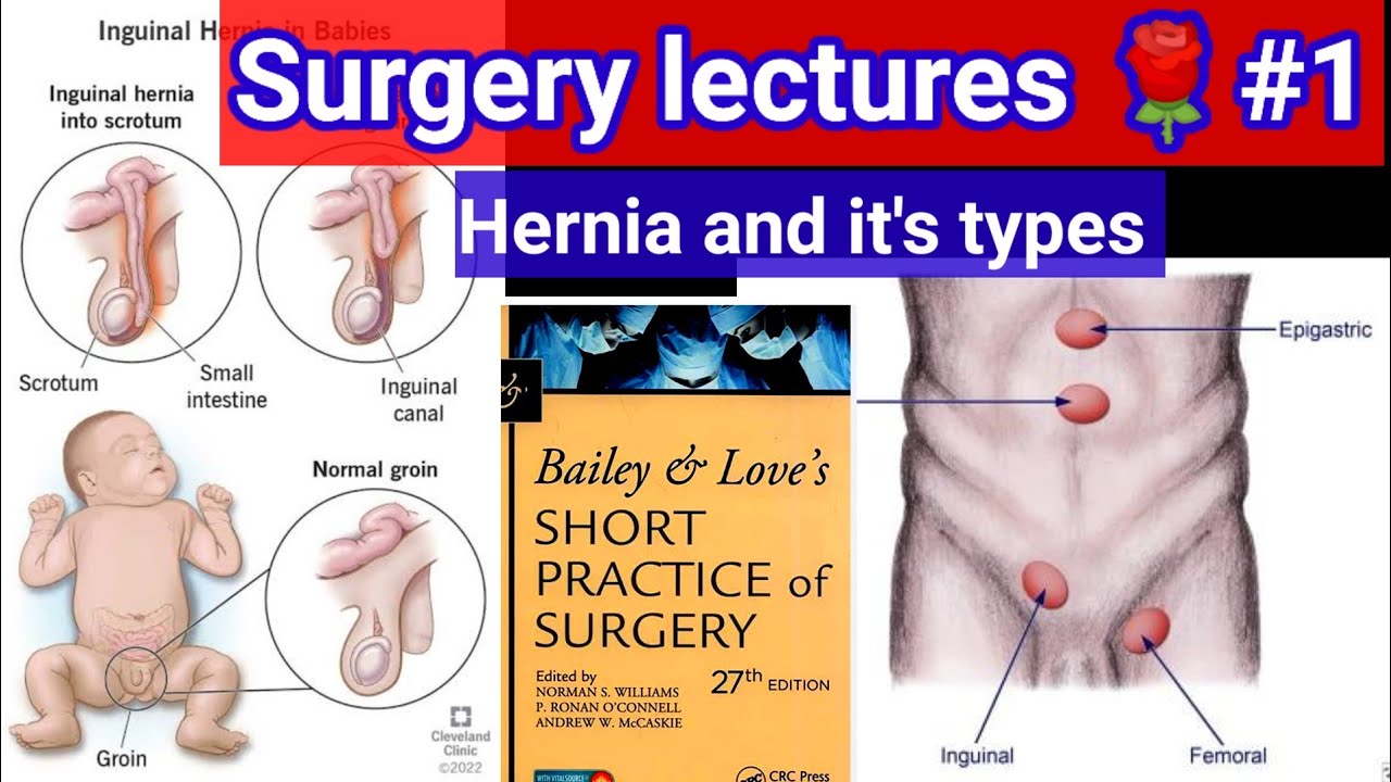 Hernias. Systemic Surgery Lecture #1 🌹 Types of Hernia. Direct, indirect hernia, inguinal hernia ...