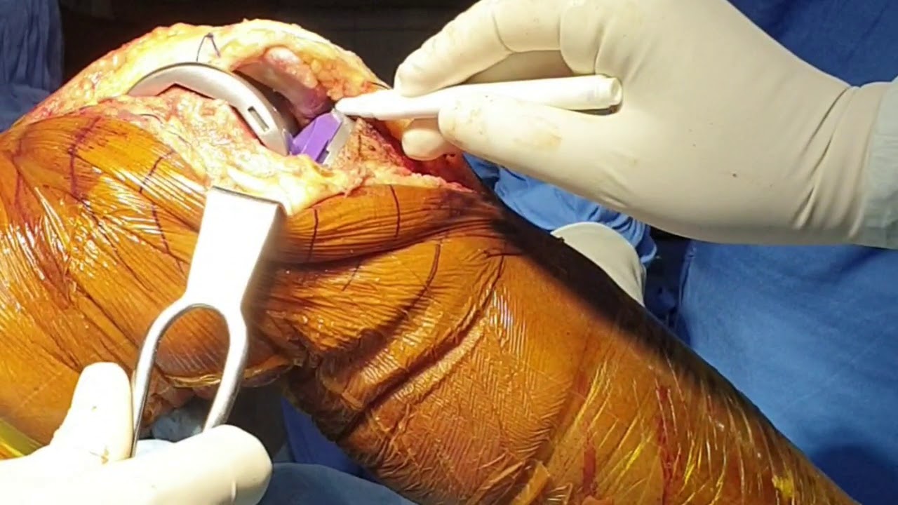 Total knee replacement in patella infera or Baja by Dr Arun Gupta, Agra ...