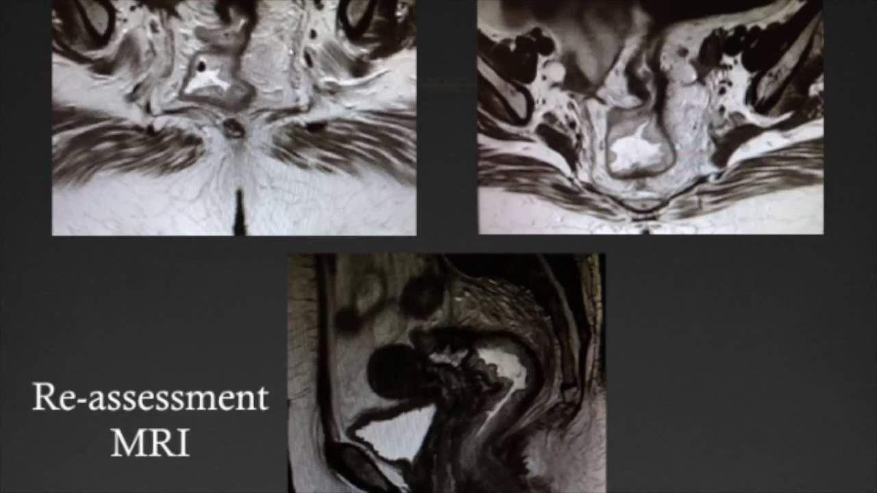 Robotic-asst Low Anterior Resection: Beyond TME–Left Vascular Approach ...
