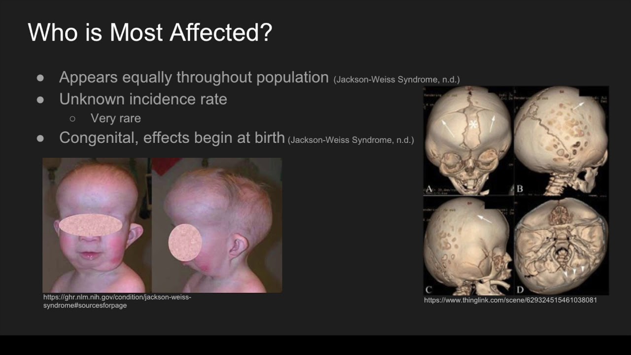 Jackson-Weiss Syndrome - YouTube