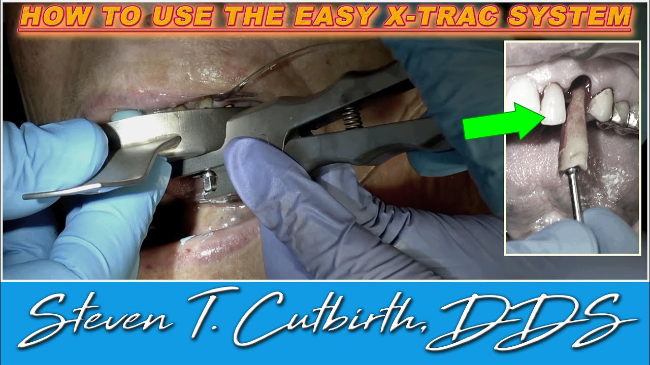 How to Use the Easy X-Trac System - Dental Minute with Steven T ...