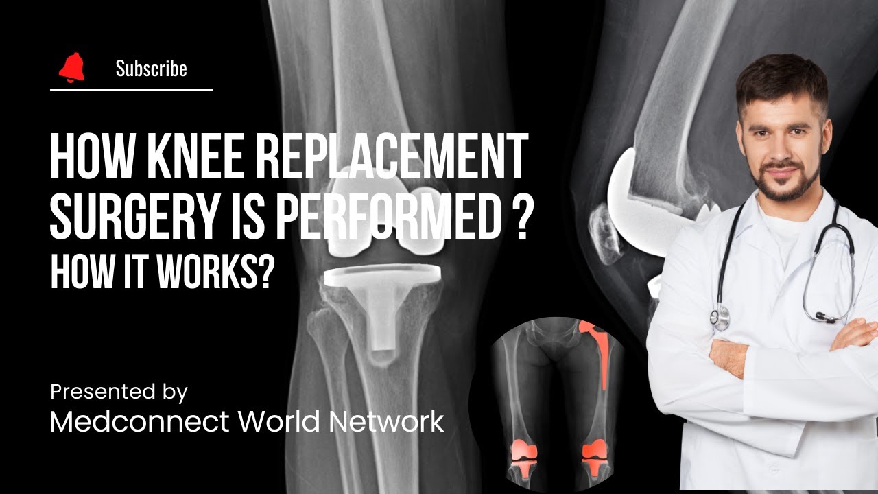 How Knee Replacement Surgery Is Performed ? || How It Works ...