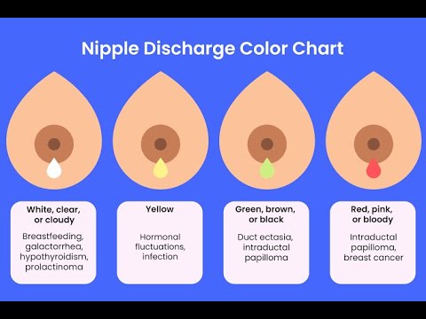 Nipple Discharge Definition Types Normal Discharge Abnormal