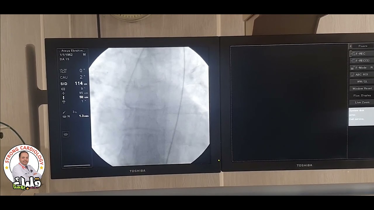 Coronary Saline assisted coronary engagement, Dr Alaa Nasr, 2023 - YouTube