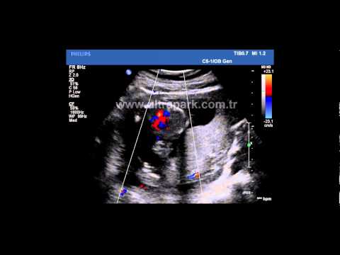 Gastroşizis antenatal fetüs