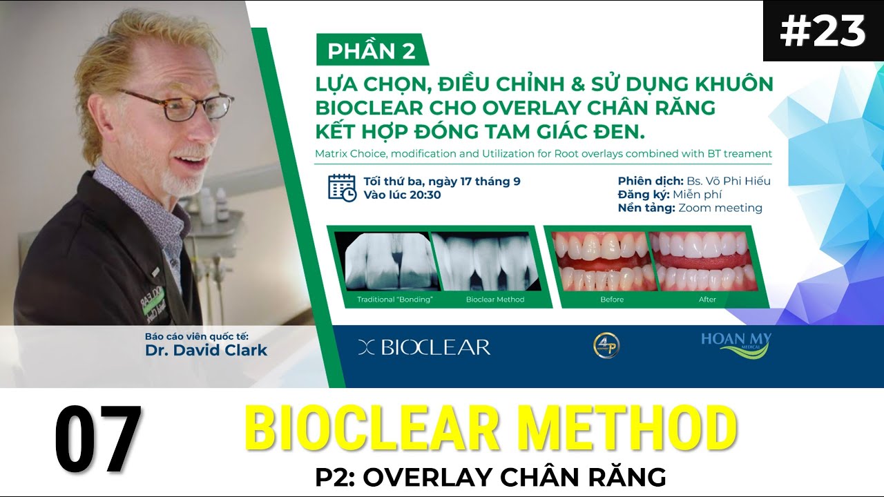 COMPOSITE | P7: BIOCLEAR METHOD - Root Overlay Răng trước - YouTube