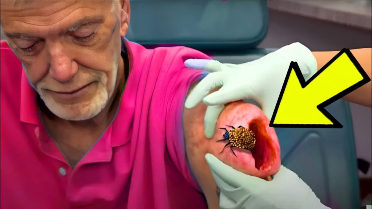 An Old Man Had a Strange Bug on His Shoulder—When Doctors Saw It, They ...