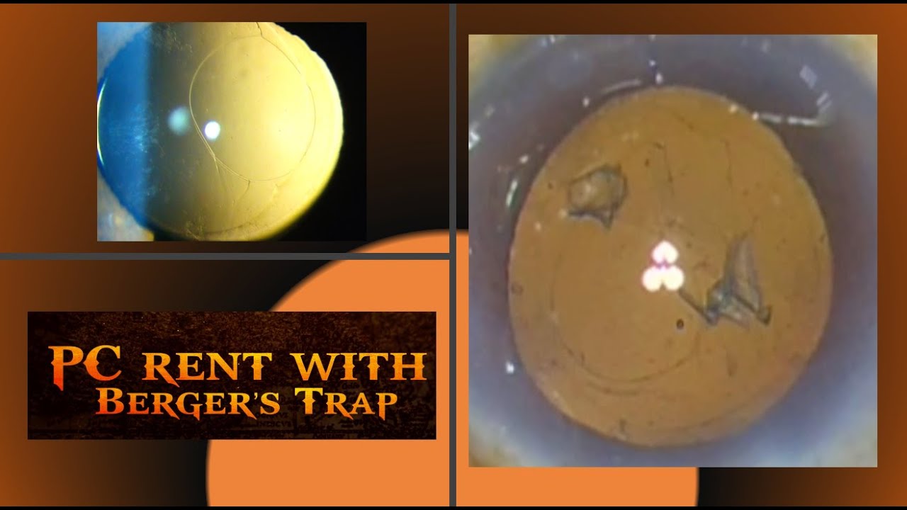 Posterior Capsular Rent with Berger's trap - a strange and unique case ...
