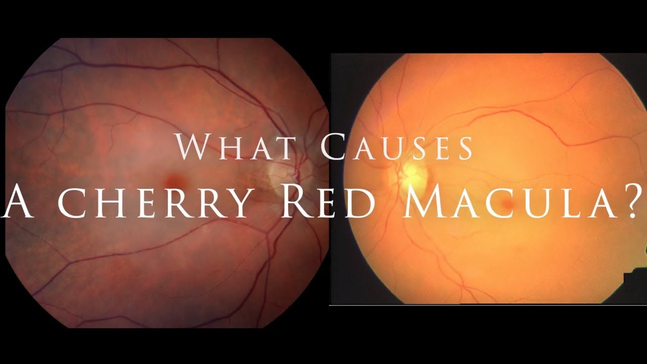 What Causes a Cherry Red Macula? - YouTube