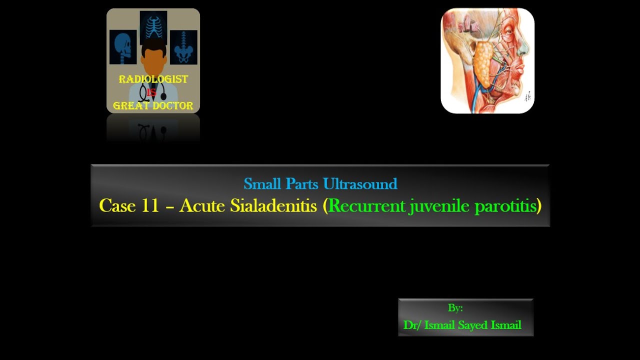 Ultrasound Case 11 - Acute Sialadenitis (Mumps Parotitis) - YouTube