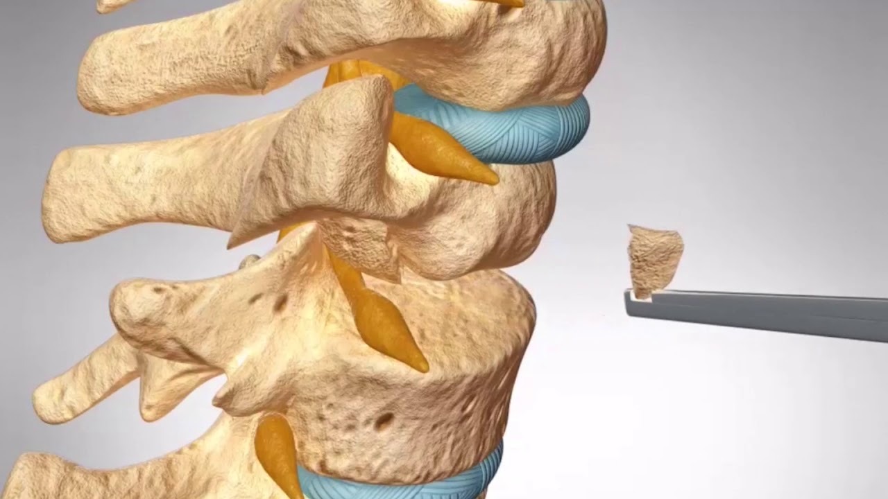 1.) Introduction to Artificial Disc Surgery - YouTube