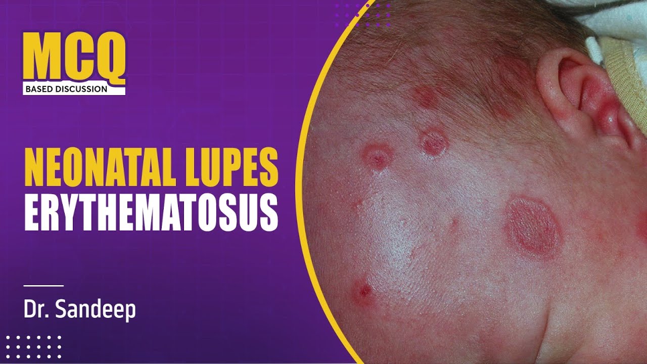 MCQ based on Neonatal Lupus Erythematosus by Dr. Sandeep Sharma ...