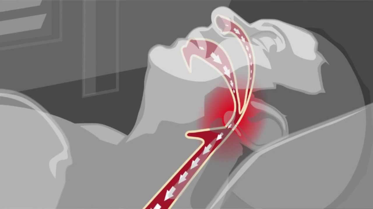 SnoreWizard - Snoring Solution - YouTube