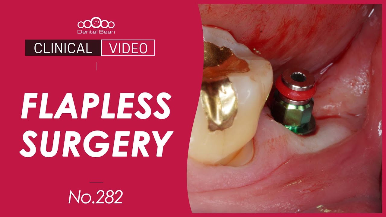 #37 Implant placement with Flapless surgery [Dr. Cho Yongseok] - YouTube