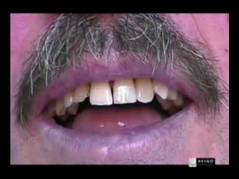 Implante Inmediato Post Extracción con su diente como Corona ...