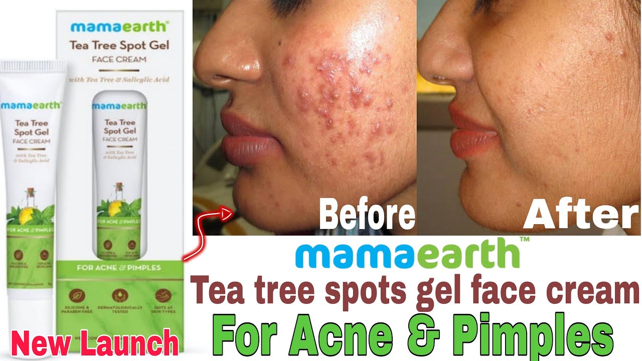 Mamaearth Tea Tree Spot Gel Face Cream / Cream For Acne and Pimples # ...