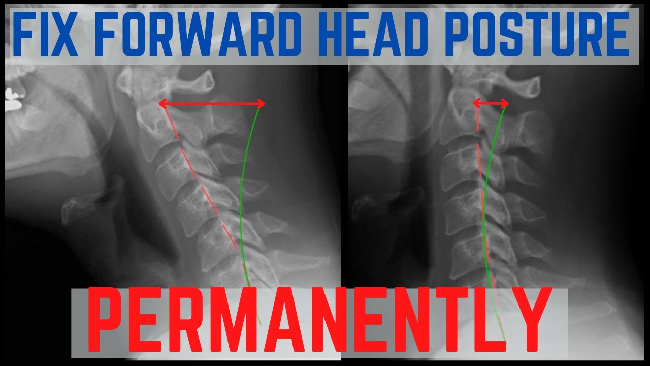 How to Fix Forward Head Posture | Fix Bad Posture | Newmarket ...