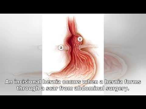 Hernia Signs and Symptoms