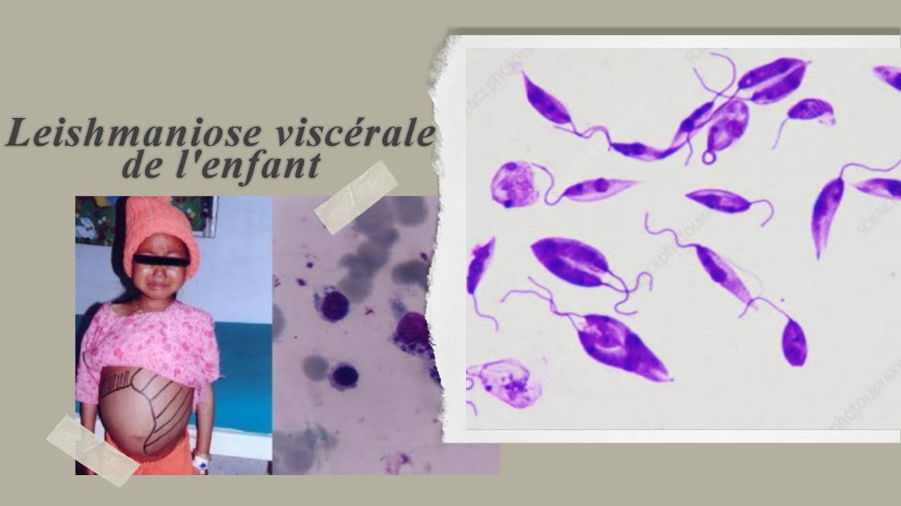 Leishmaniose viscérale de l'enfant - YouTube